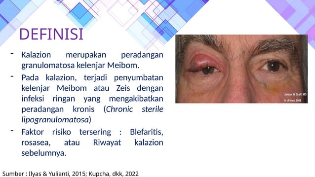 HORDEOLUM DAN KALAZION Tumor palpebra ppt.pptx