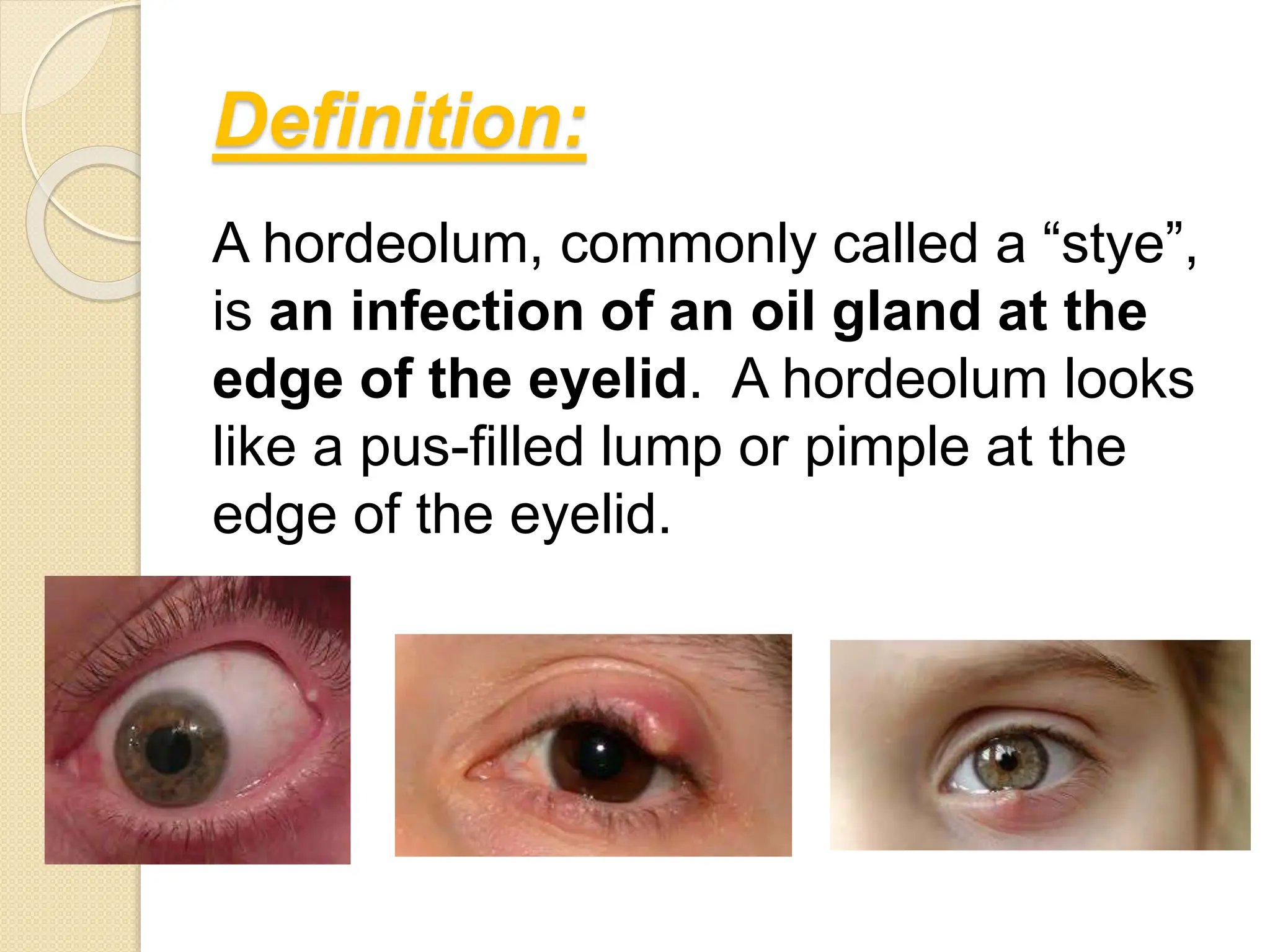 HORDEOLUM topic.pptx . | PPTX