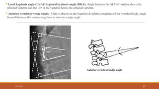 Biomechanical treatment approach for Scoliosis and Kyphosis and its ...
