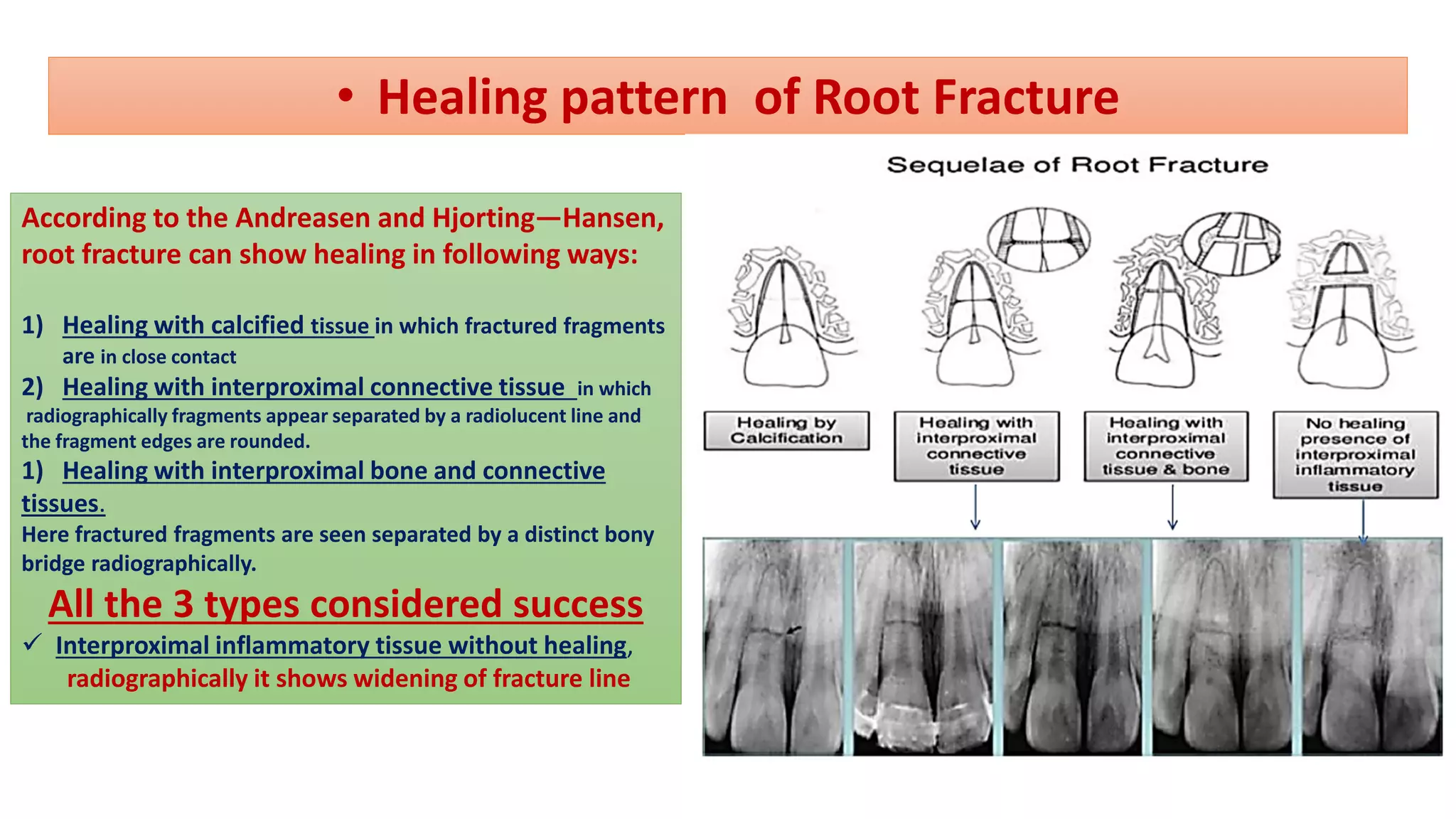 horizontal fracture .pdf