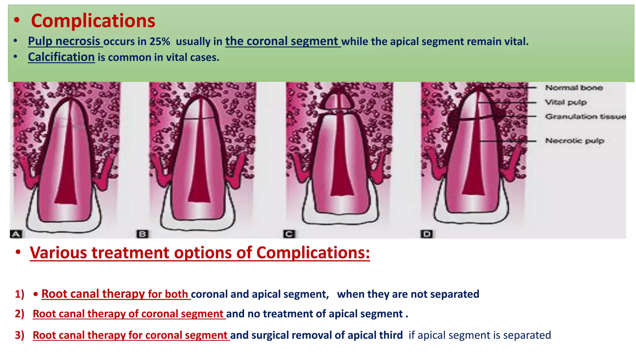 horizontal fracture .pdf