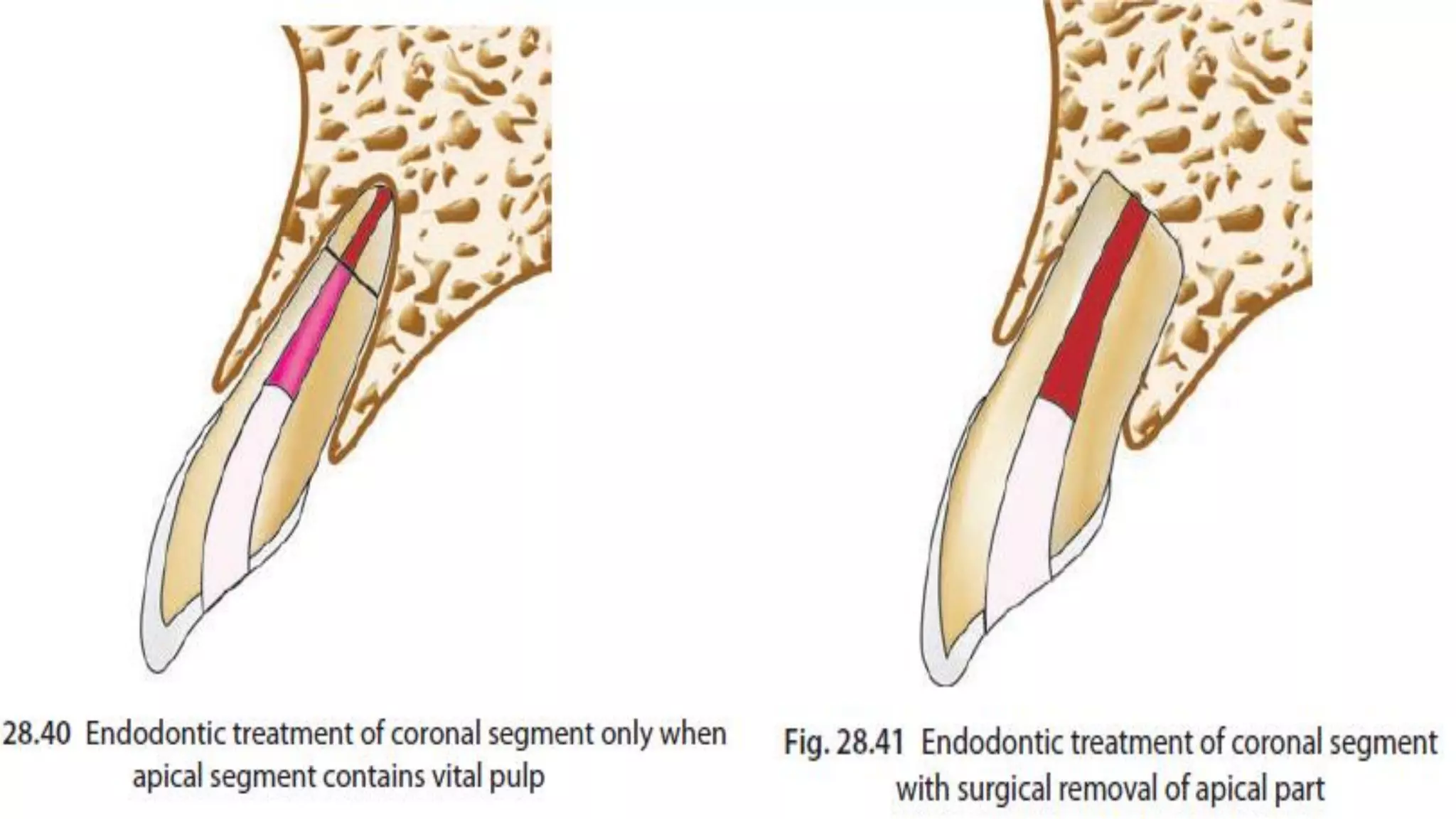 horizontal fracture .pdf