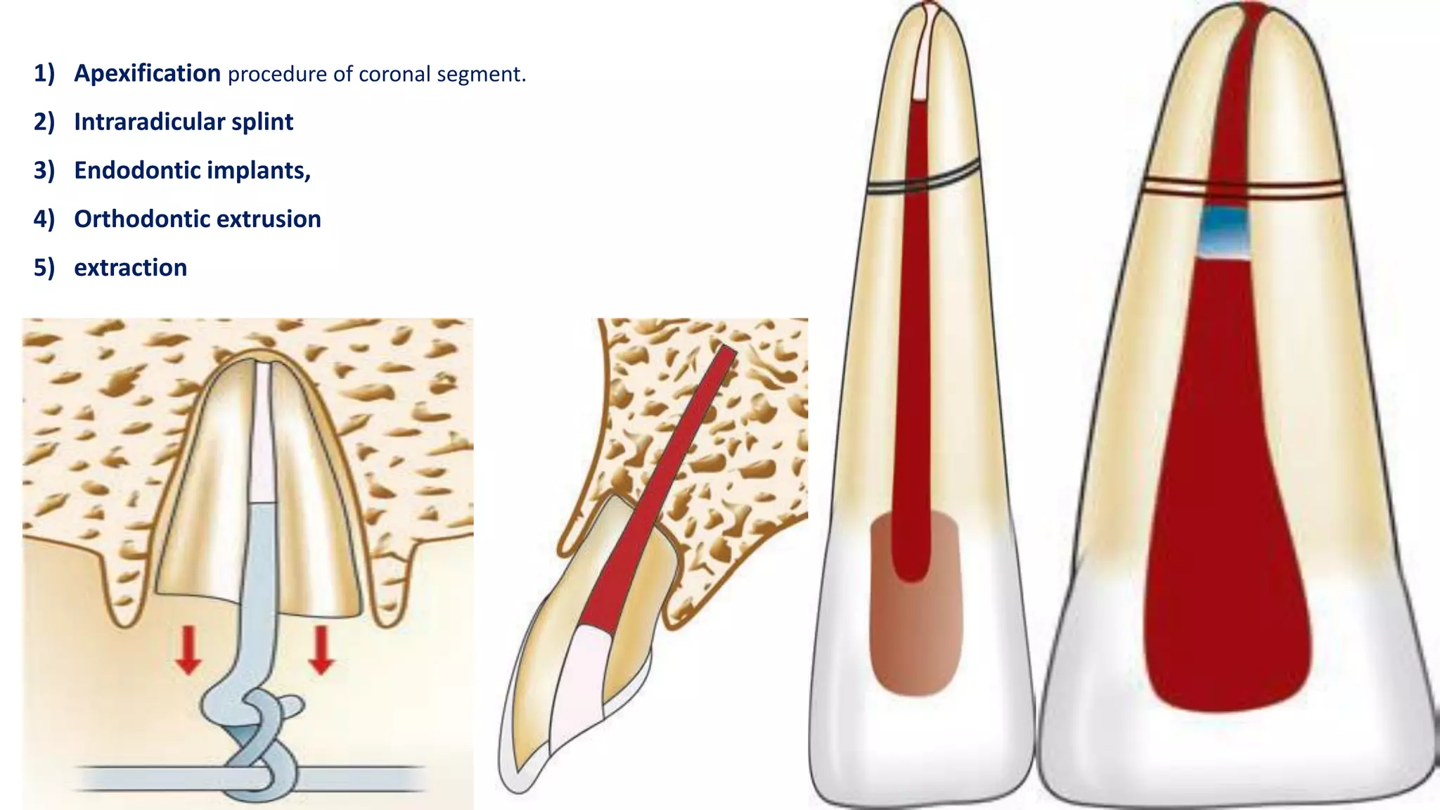 horizontal fracture .pdf