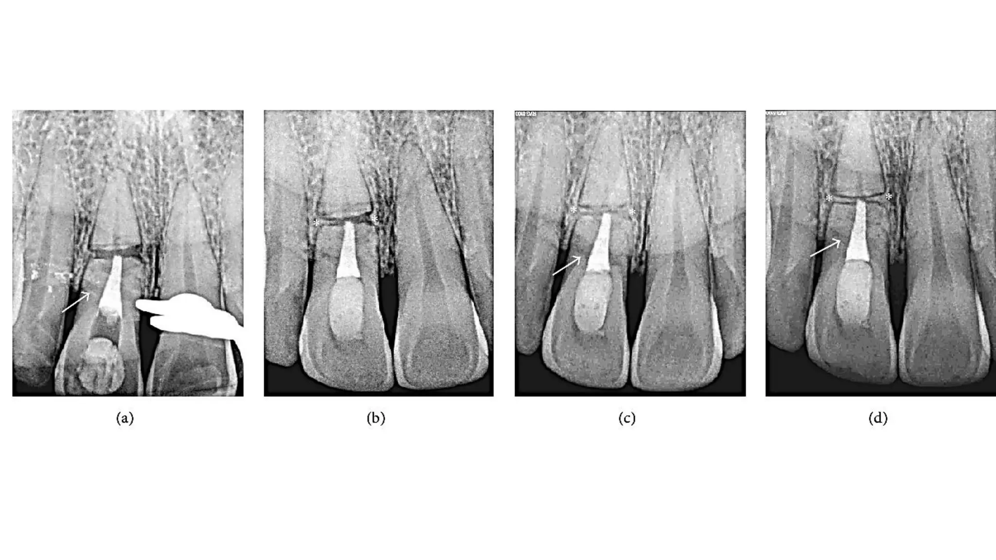 horizontal fracture .pdf