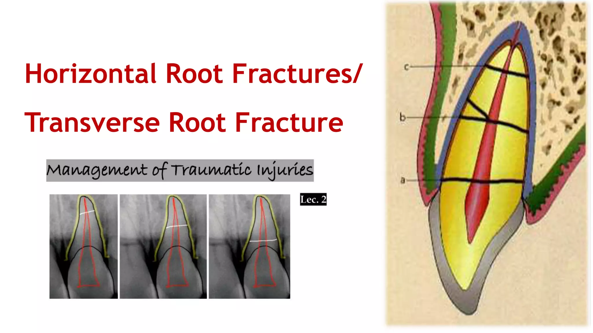horizontal fracture .pdf
