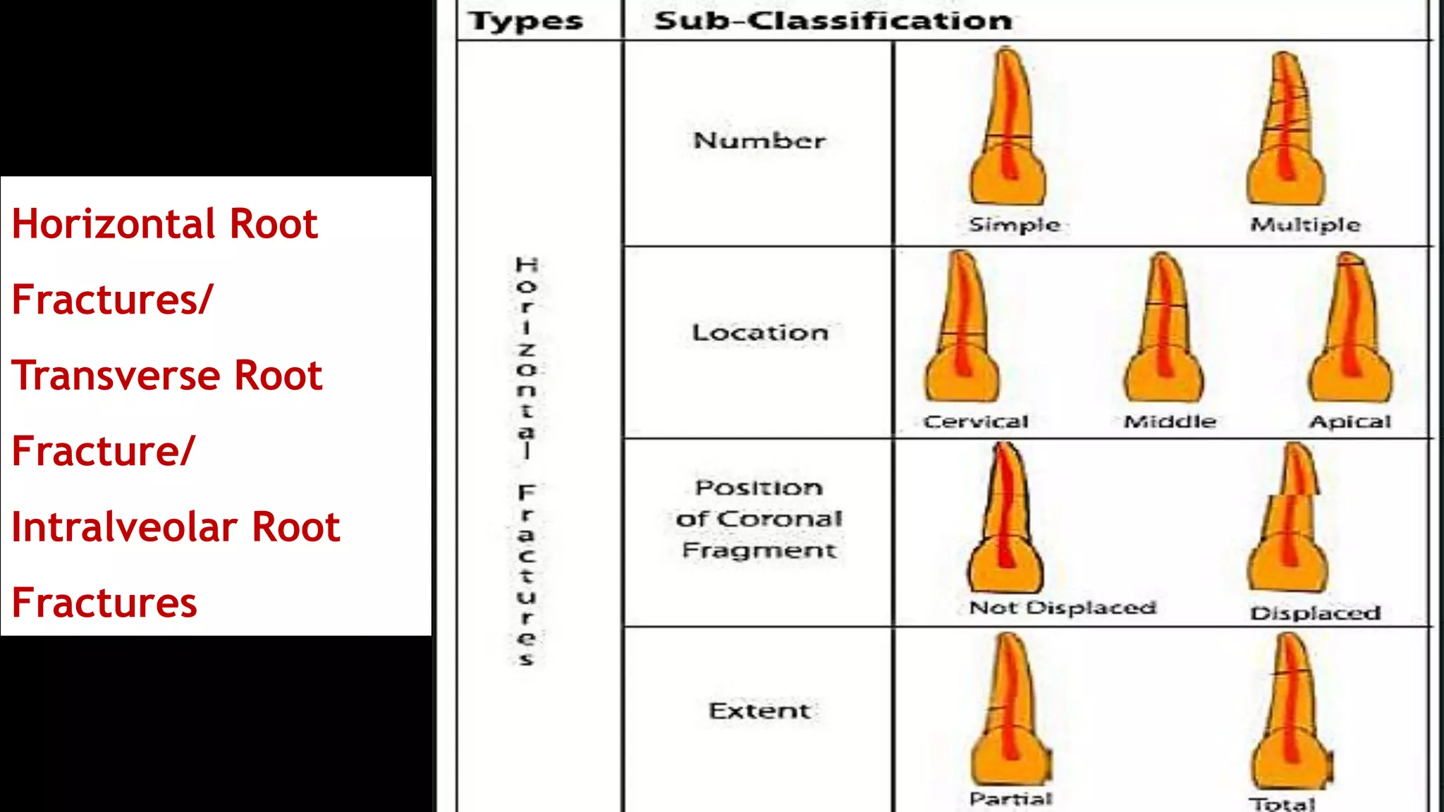 horizontal fracture .pdf