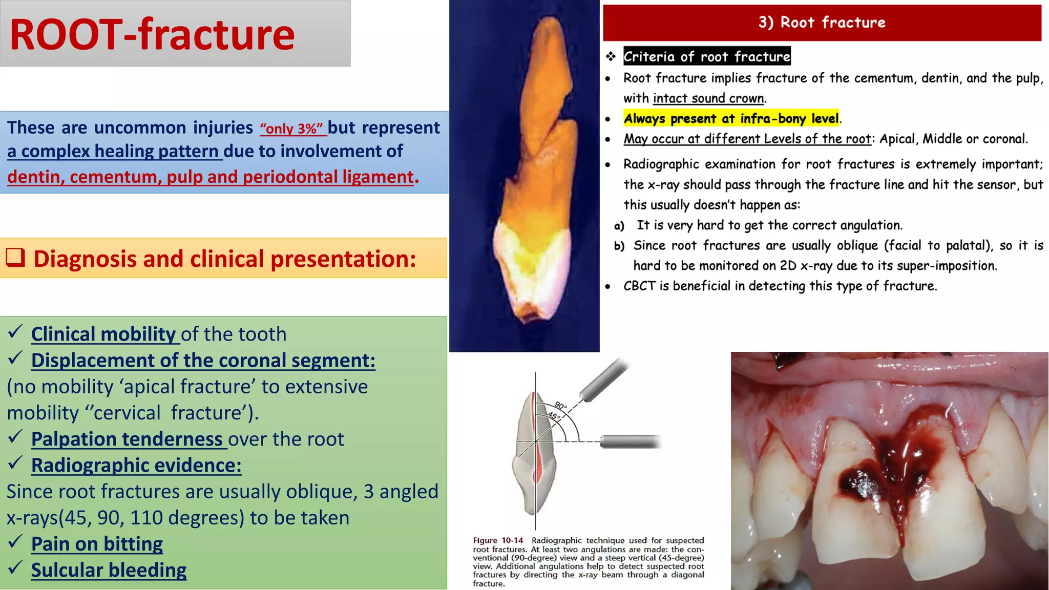 horizontal fracture .pdf