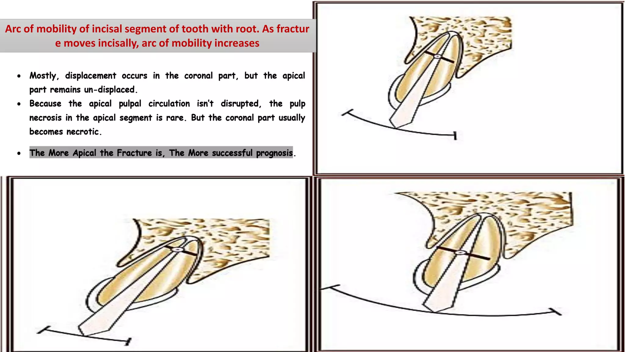 horizontal fracture .pdf
