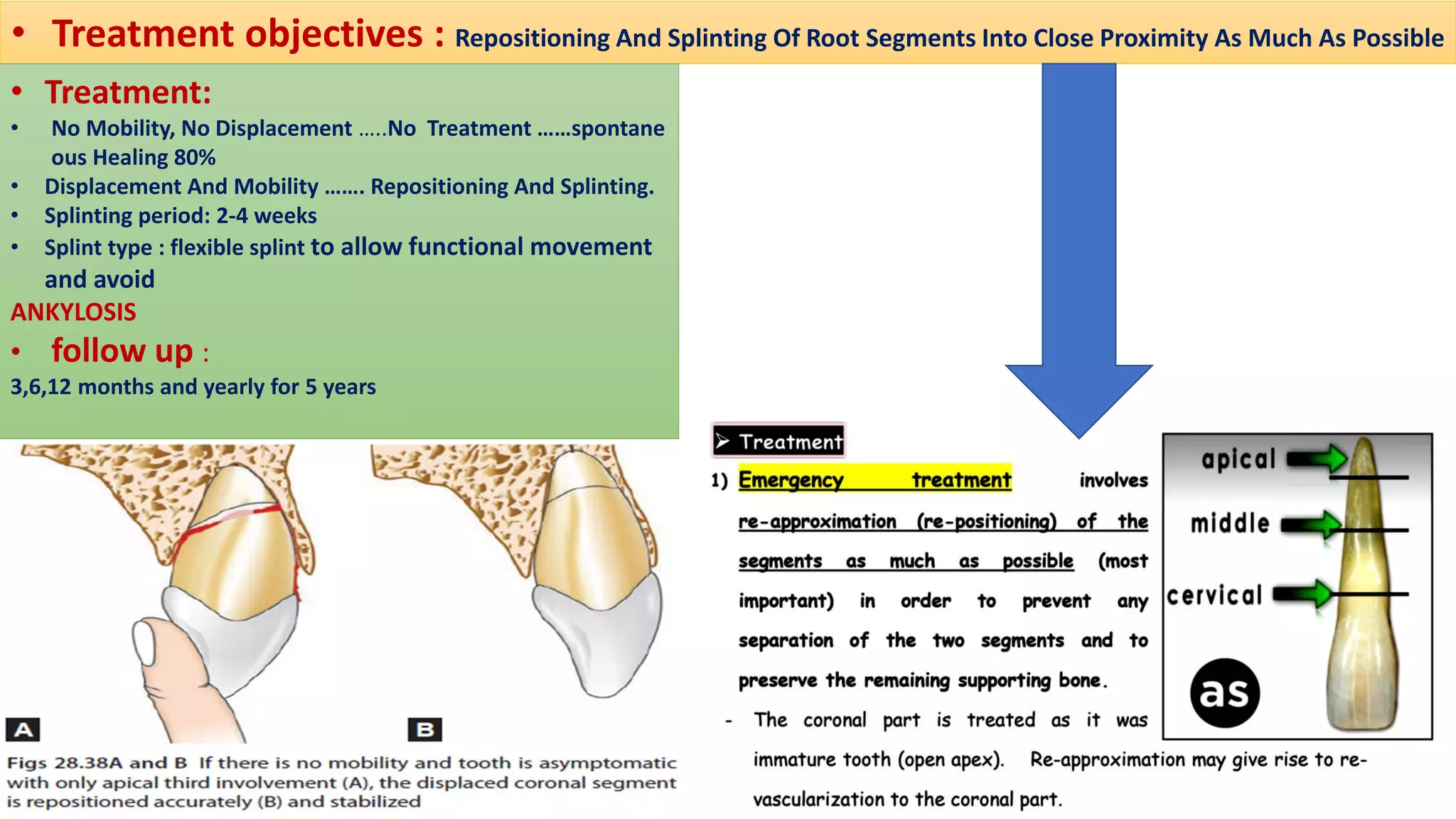 horizontal fracture .pdf