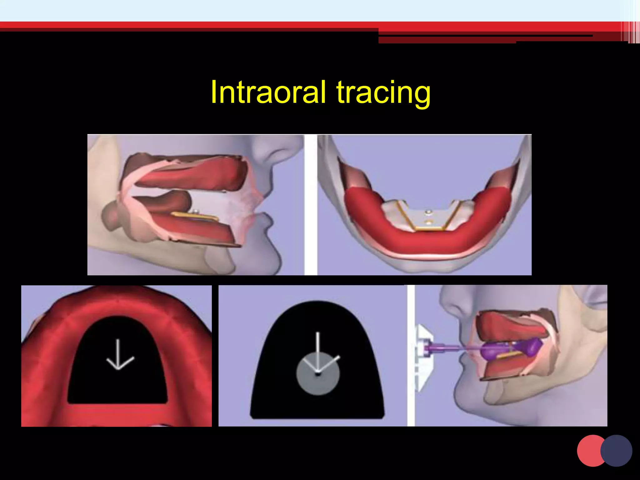 Horizontal jaw relation in complete denture | PPTX