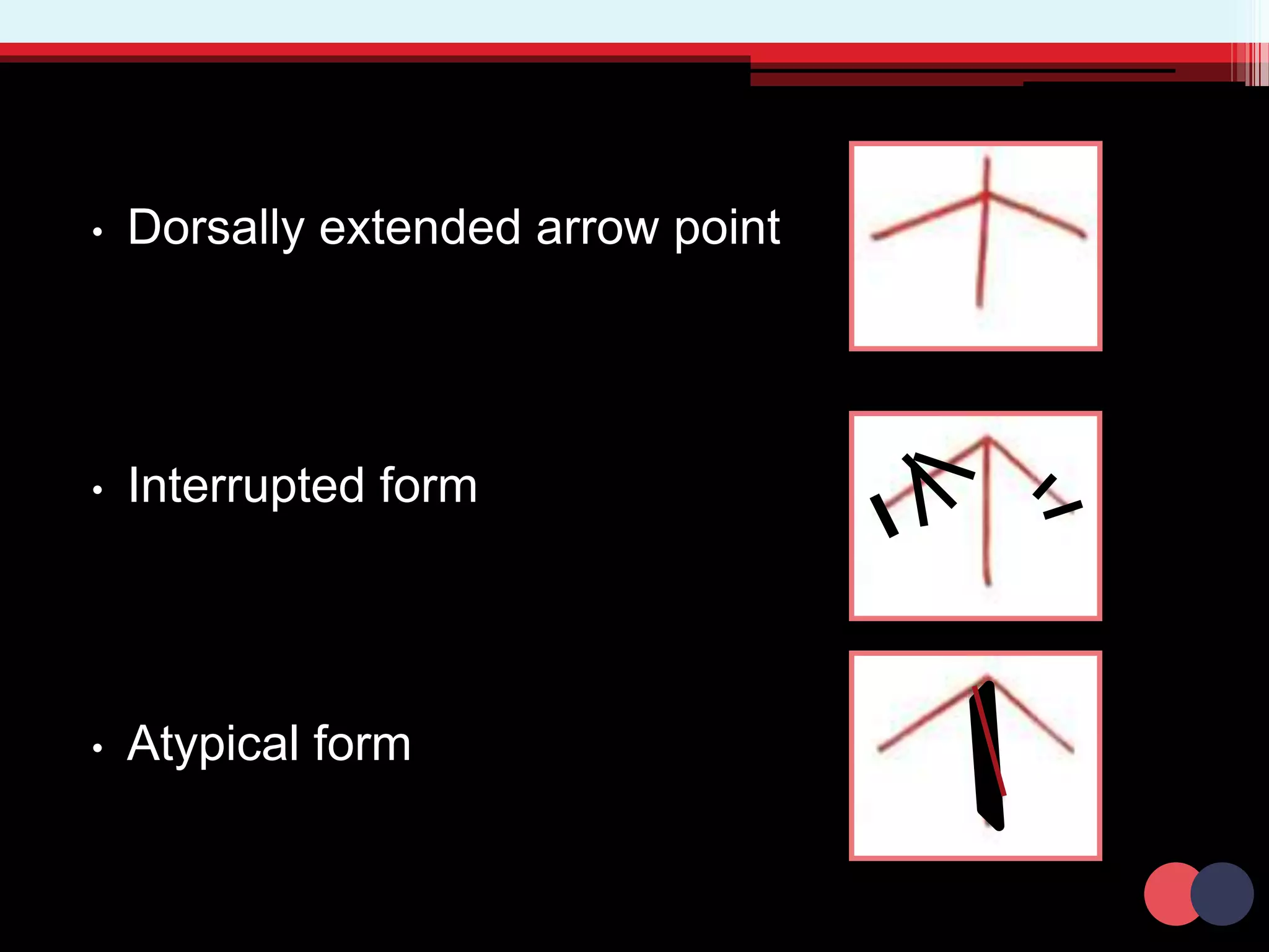 Horizontal jaw relation in complete denture | PPTX