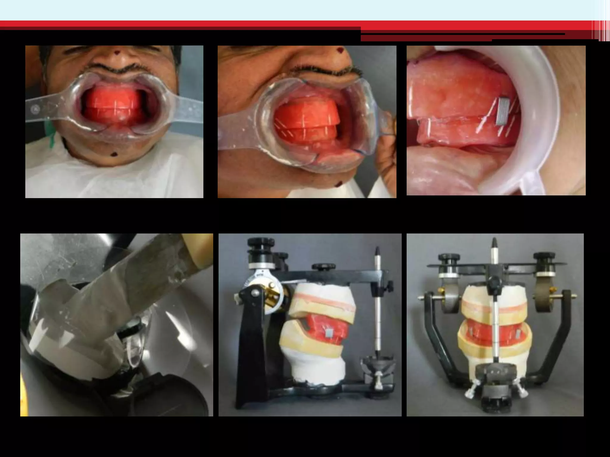 Horizontal jaw relation in complete denture | PPTX