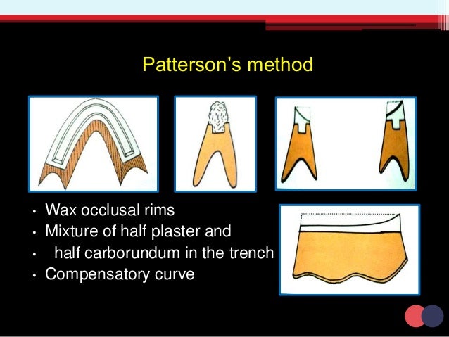 Horizontal jaw relation in complete denture