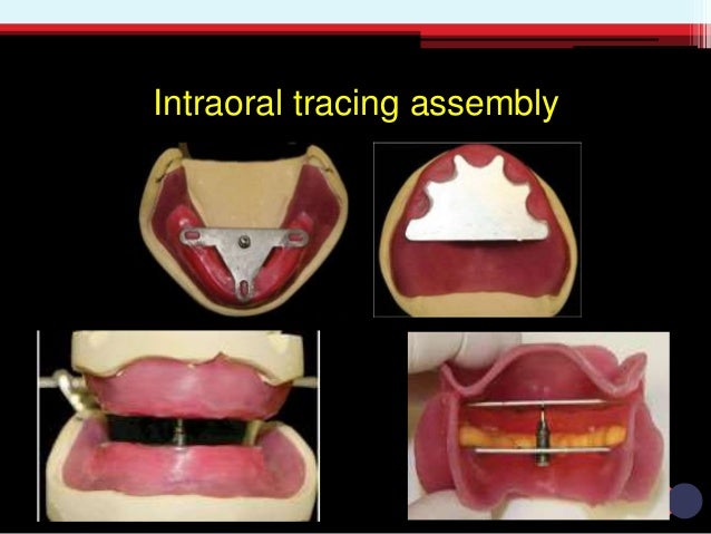 Horizontal jaw relation in complete denture