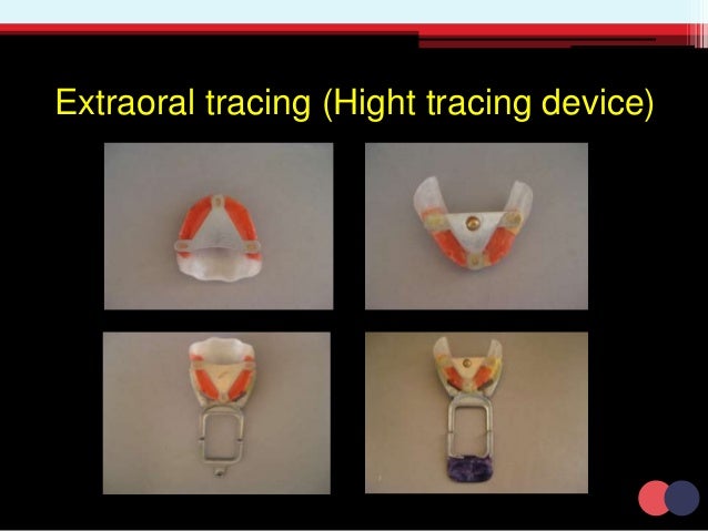 Horizontal jaw relation in complete denture