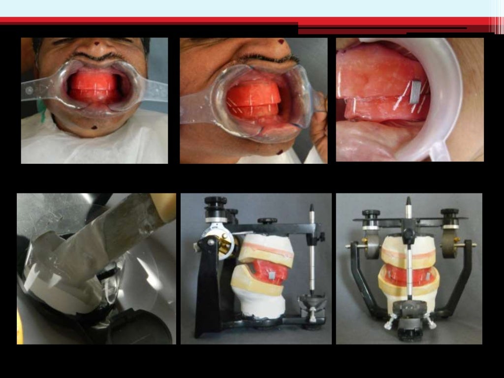 Horizontal jaw relation in complete denture