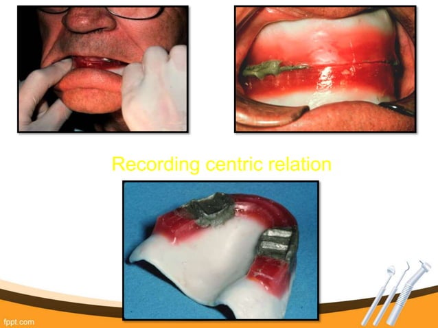Horizontal jaw relation -prosthodontics | PPTX | Dental Health ...