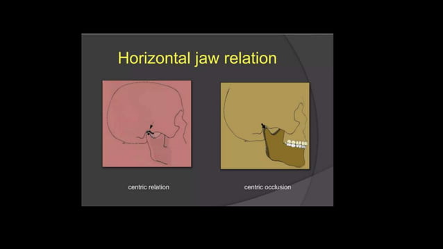 HORIZONTAL JAW RELATIONS - jaw relation pptx | PPT