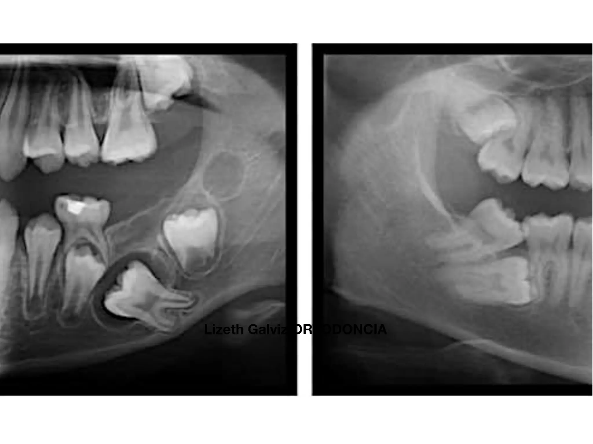 Impacted molar -tercer molar impactado . | PDF
