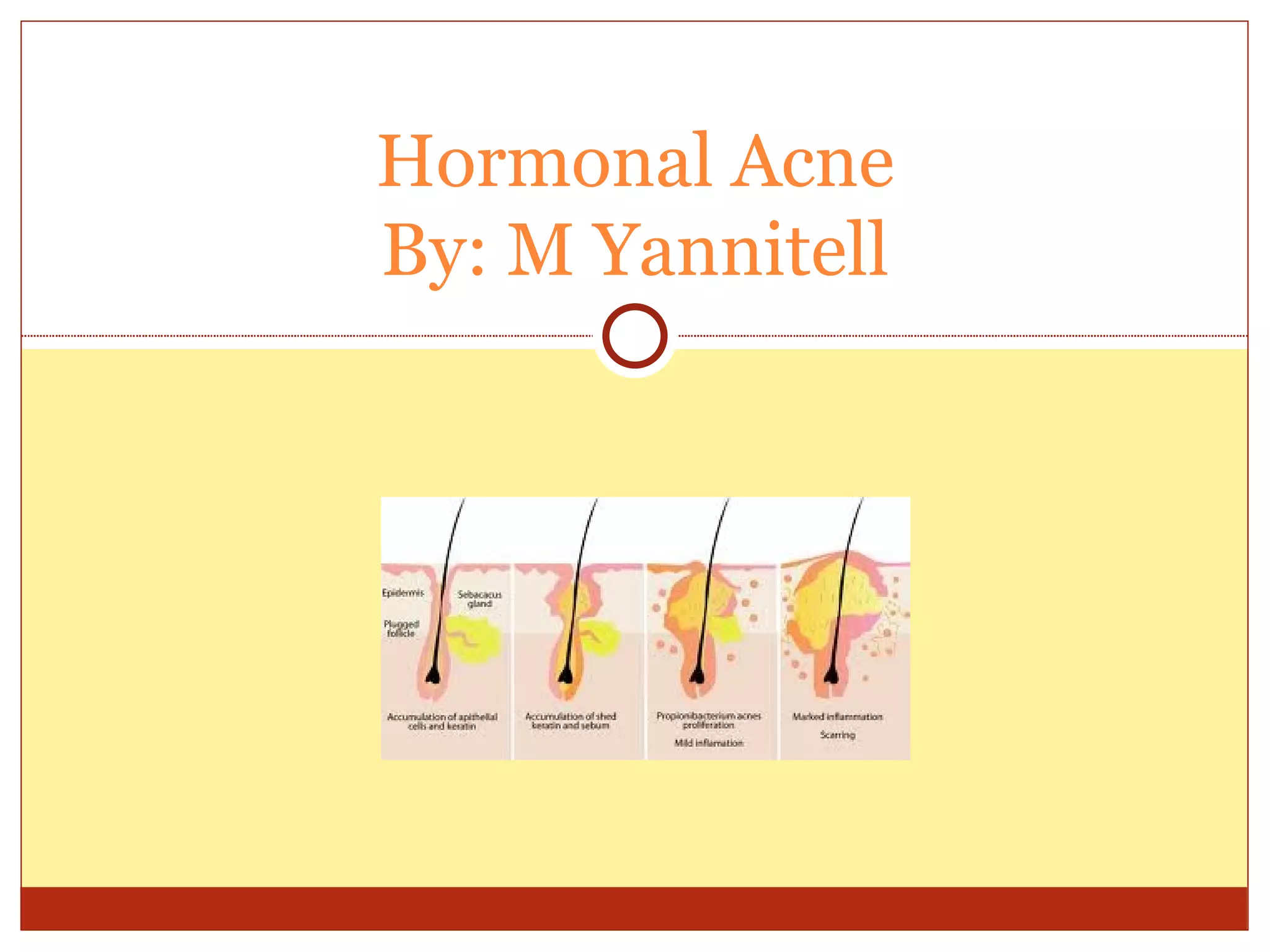 Hormonal Acne Copy Ppt