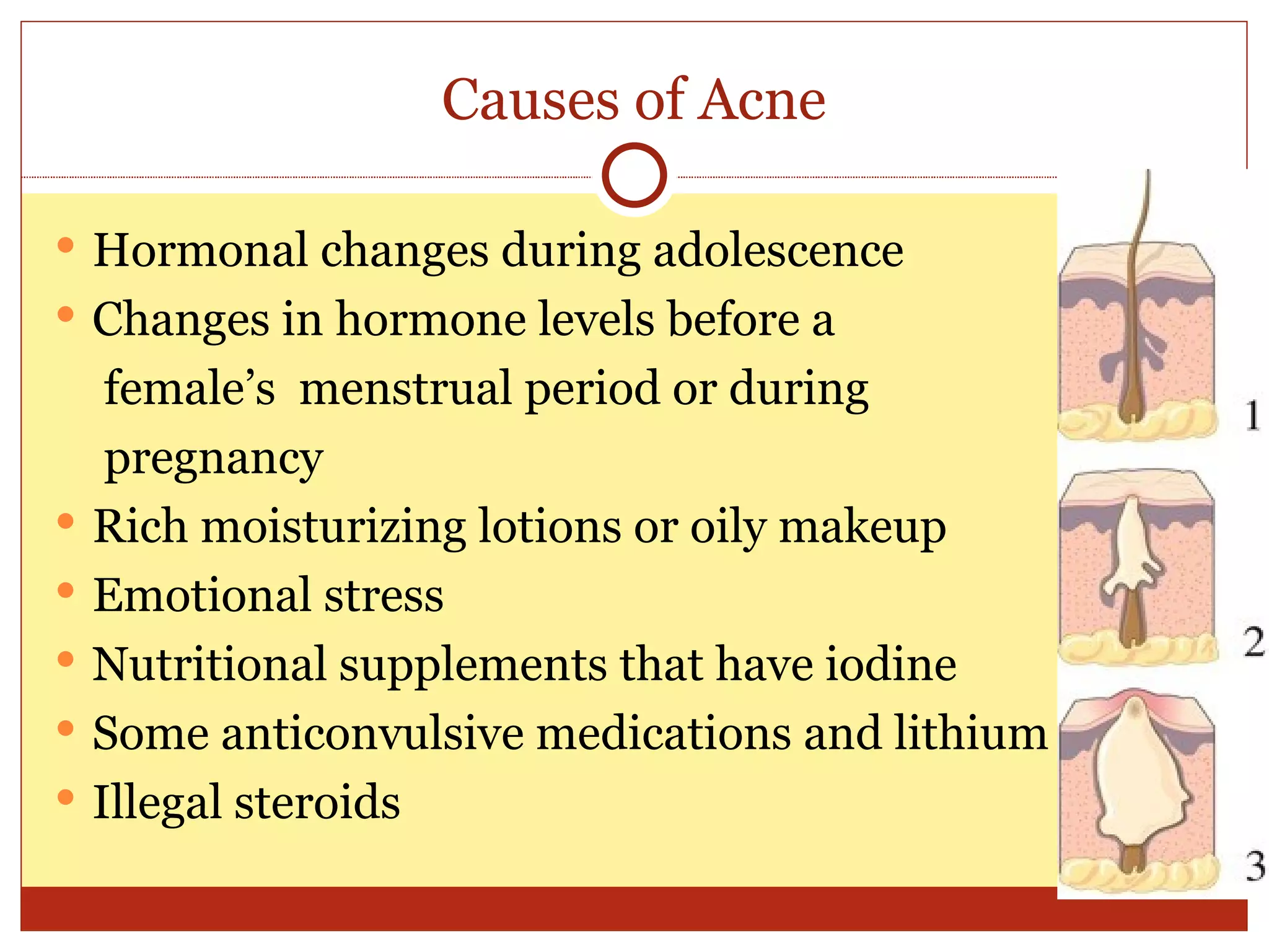 Hormonal acne copy | PPT
