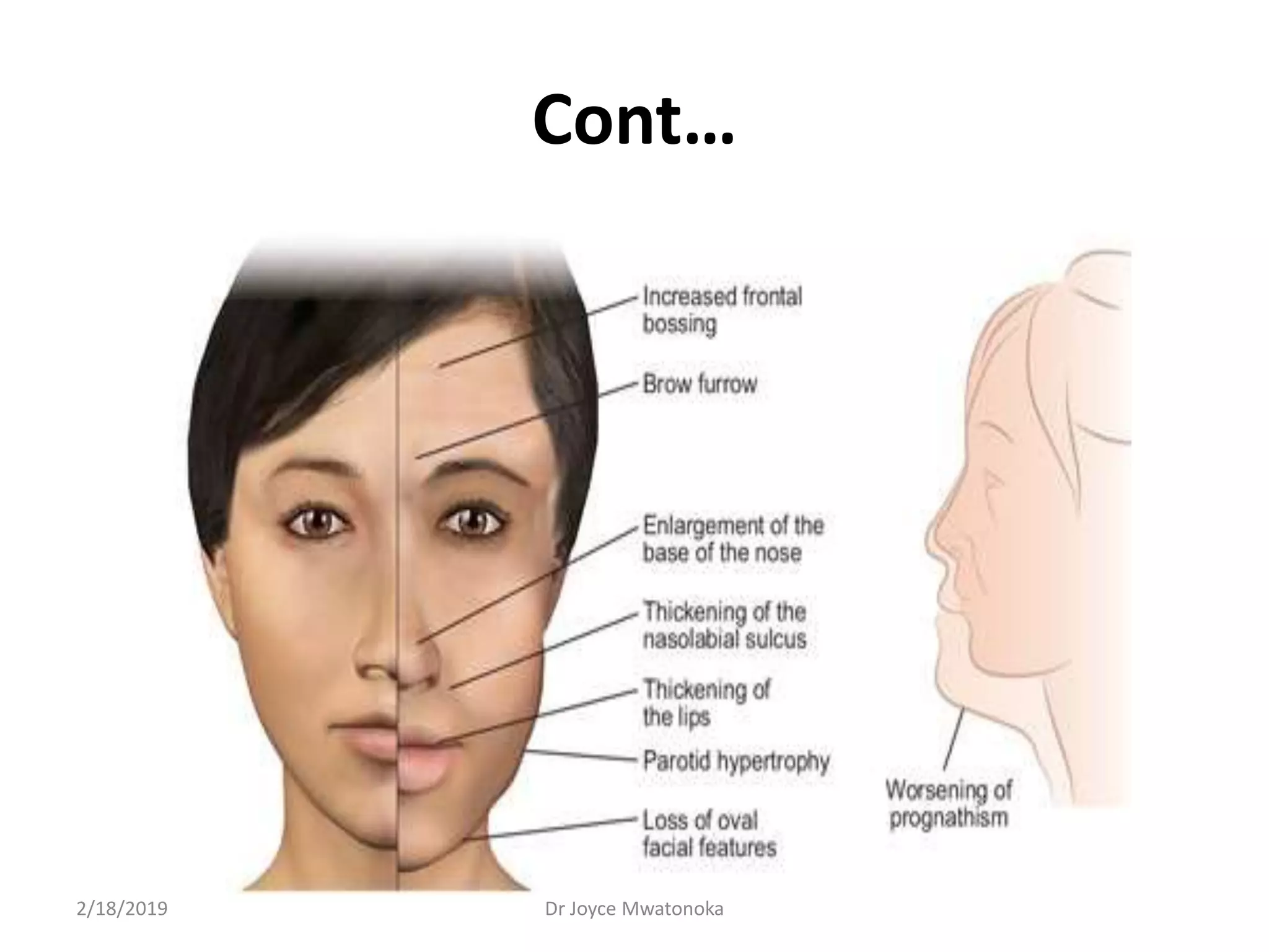Hormones Of Pituitary Gland And Its Disorders Ppt
