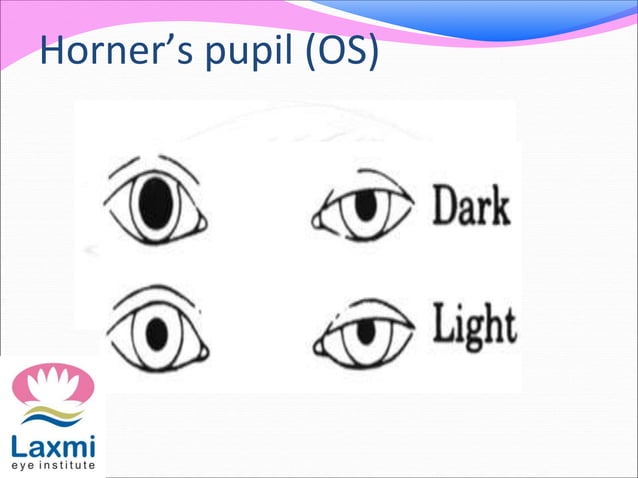 Horners syndrome | PPTX