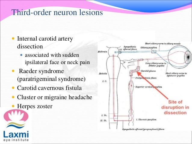 Horners syndrome