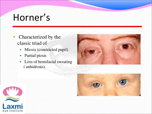 Horners syndrome