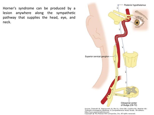 Horner's syndrome | PPTX