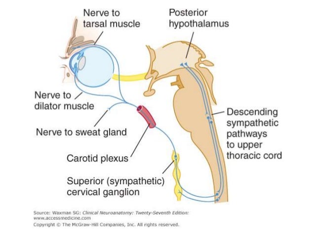 Horner's syndrome