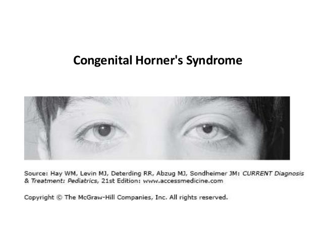 Horner's syndrome