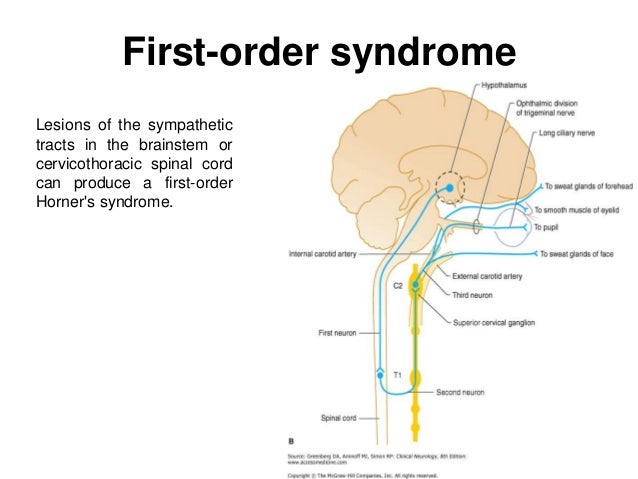 Horner's syndrome