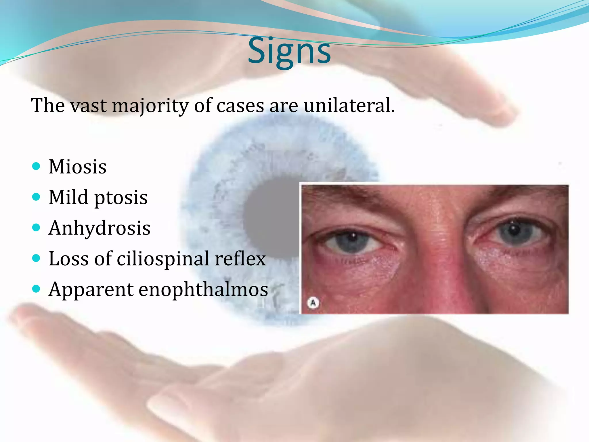 Horners syndrome | PPTX