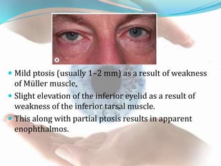 Horners syndrome | PPTX