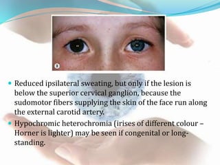 Horners syndrome | PPTX