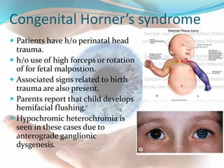 Horners syndrome | PPTX