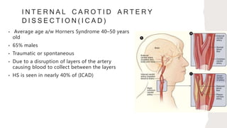 Horner's syndrome | PPTX