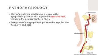 Horner's syndrome | PPTX