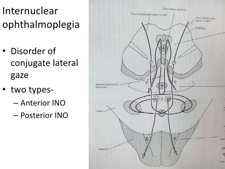 Horner's syndrome and Internuclear ophthalmoplegia