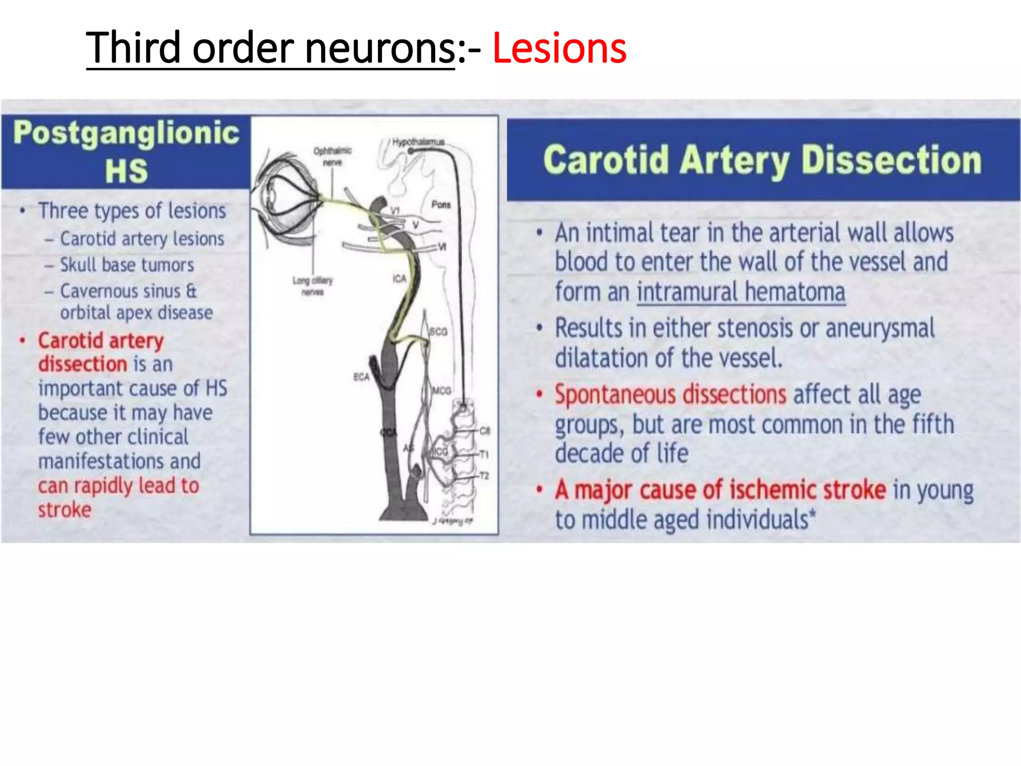 Horner syndrome. Horner's syndrome | PPTX