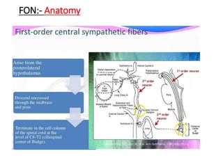 Horner syndrome. Horner's syndrome | PPTX