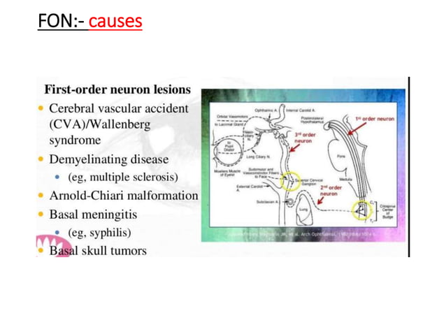 Horner syndrome. Horner's syndrome | PPTX | Eye and Vision Conditions ...