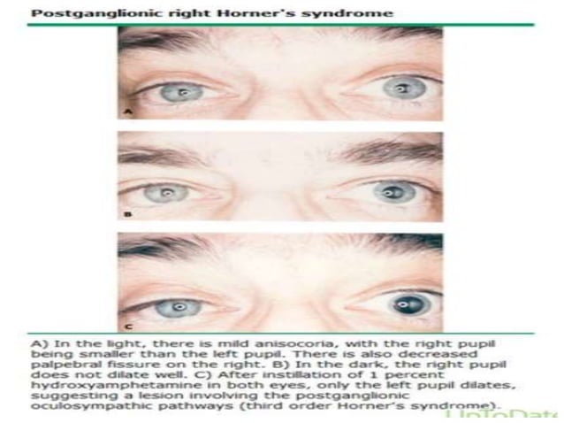 Horner syndrome. Horner's syndrome | PPTX | Eye and Vision Conditions ...