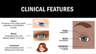 Horner syndrome copy copy.pptx…………………….. | PPTX