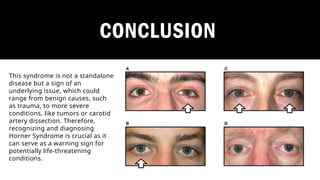 Horner syndrome copy copy.pptx…………………….. | PPTX