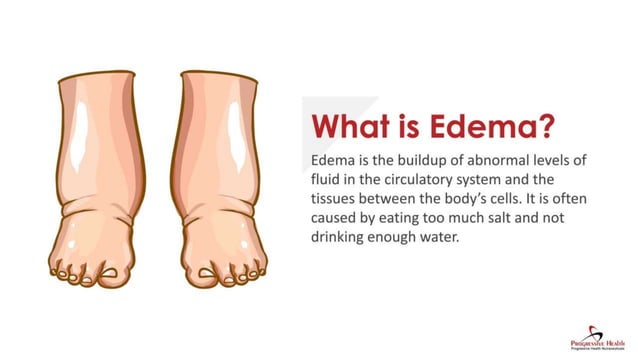 Horse Chestnut and Edema | PPTX