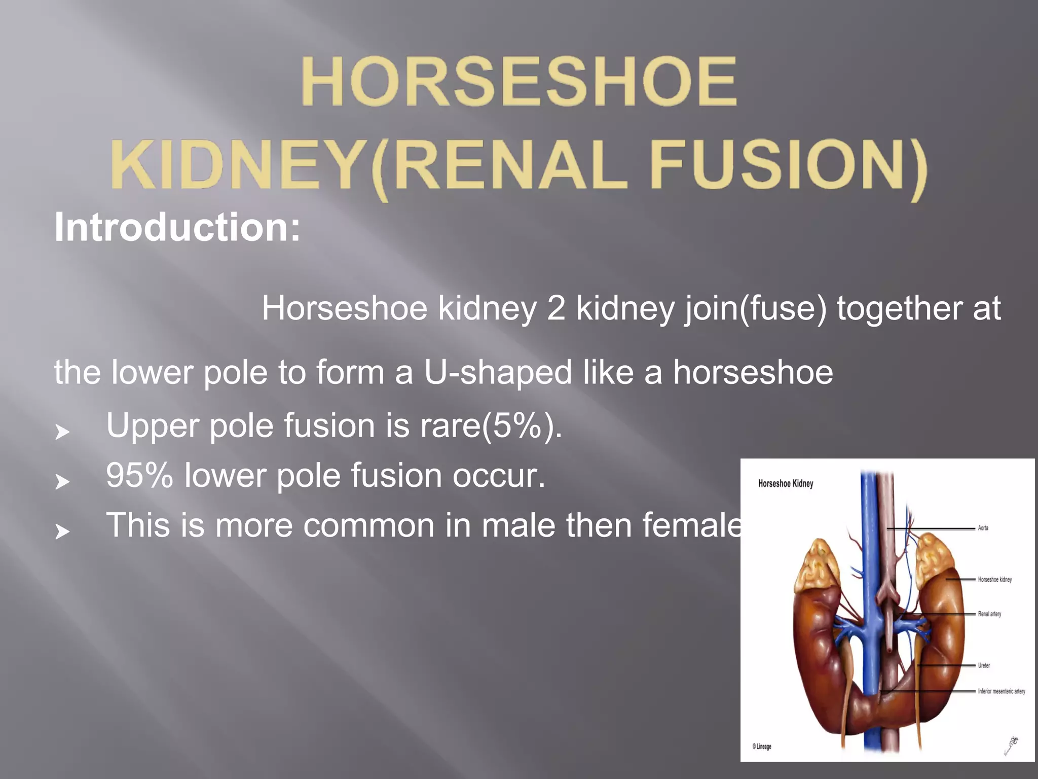 Horseshoe Kidney .pdf