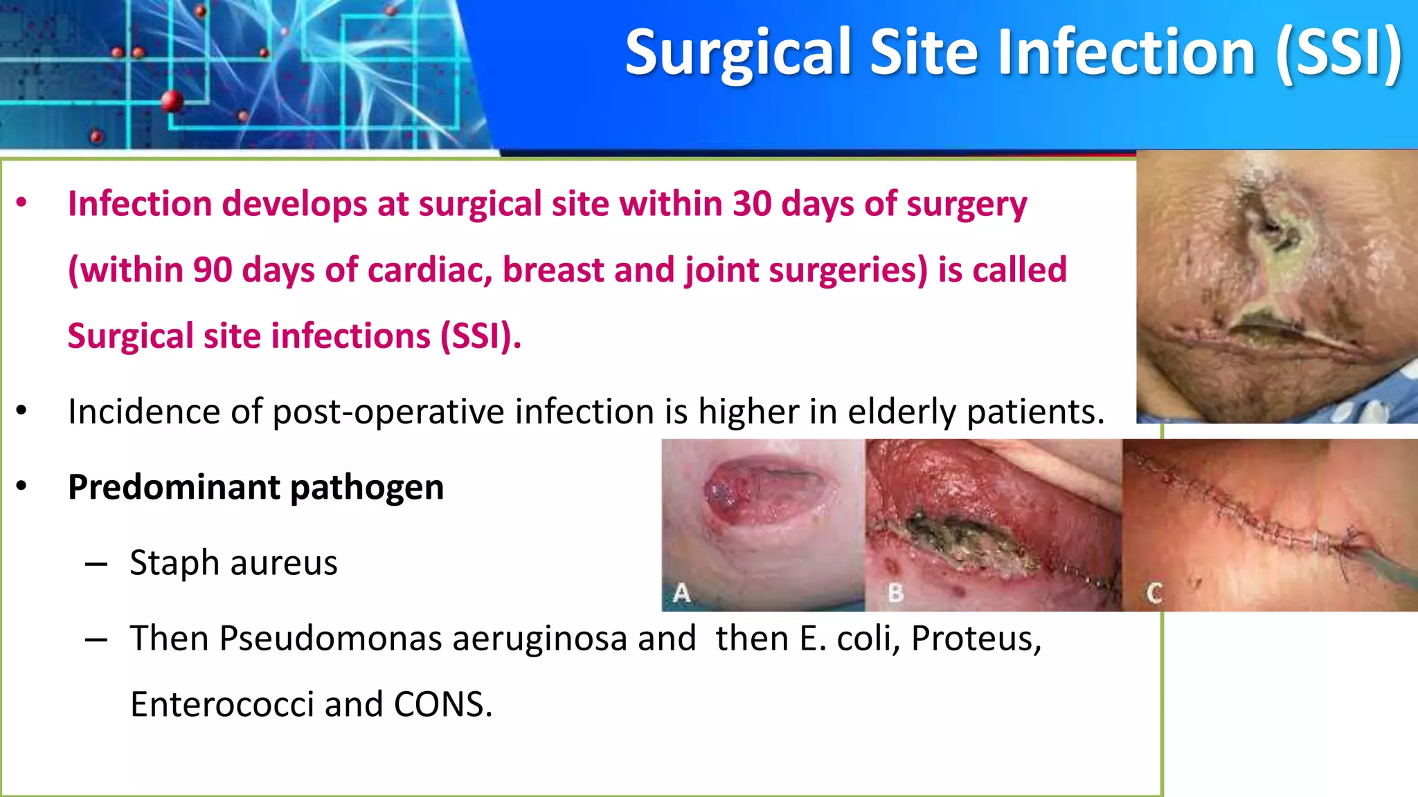Hospital Acquired Infection | PPTX