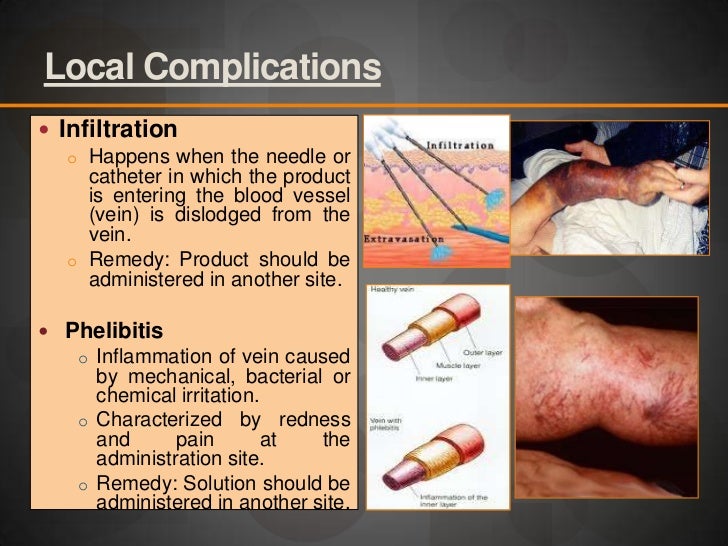 Nursing Iv Complications Phlebitis Infiltration